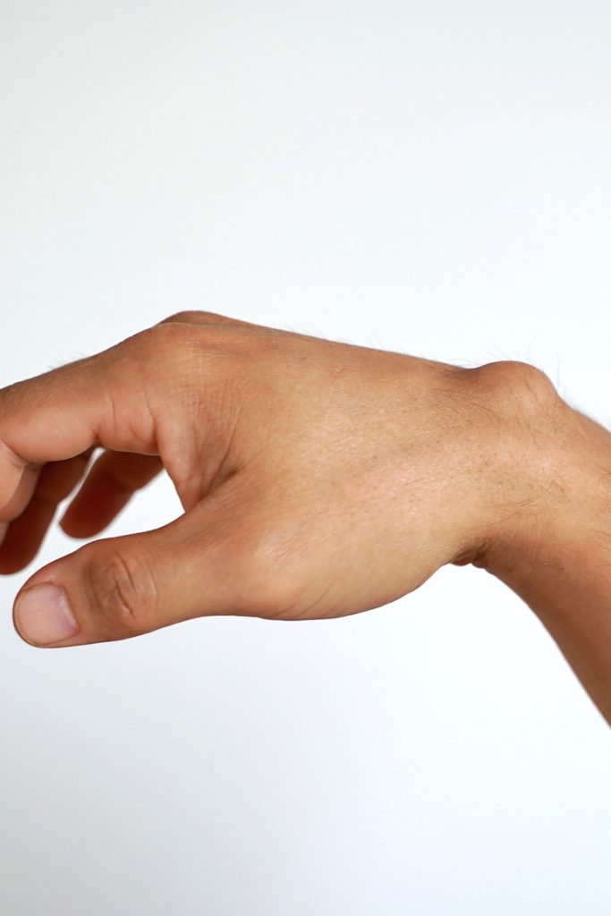 About Ganglion Cysts - Florida Hand Center